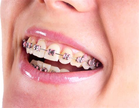 Ортодонтска клиника брекети за възрастни и деца Orthoestet