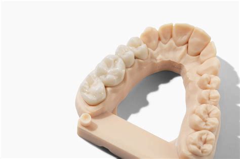 Dental Code Alveoplasty A Comprehensive Guide