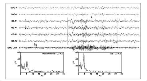 Cyclic Alternating Pattern A3 Subtype Characterized By Predominant