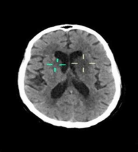 Non Contrast Computed Tomography NCCT Of The Brain Showing
