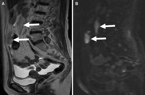 2a 45 Year Old Woman With Peritoneal Metastases From Ovarian Cancer A