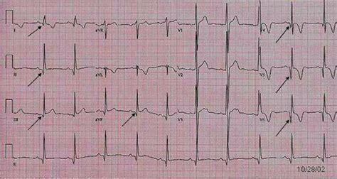 Emergency Medicine Educationpediatric Syncope Emergency Medicine