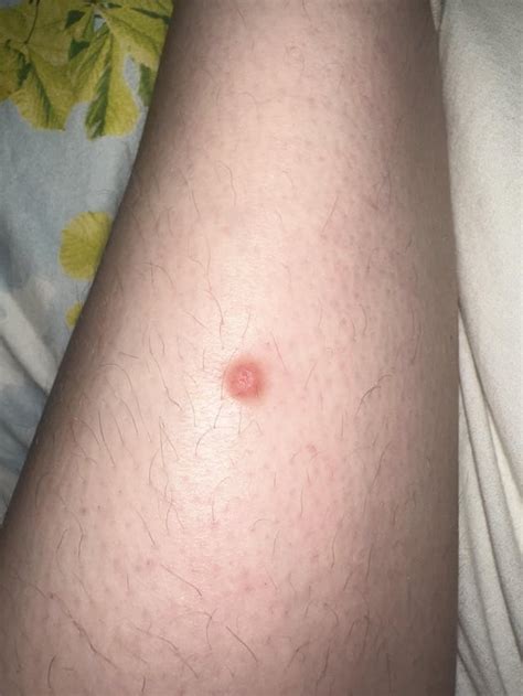 Raised Bump On Leg Rdermatologyquestions