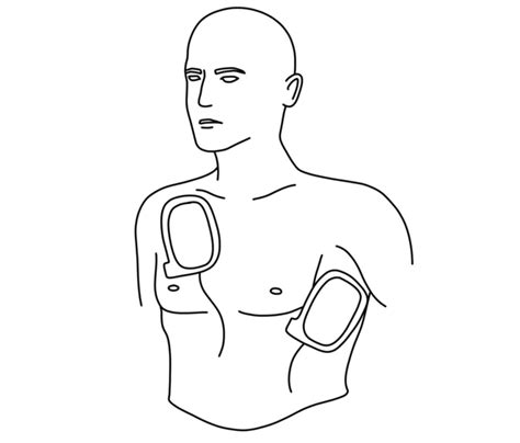 Direct Current Dc Cardioversion Osce Guide Geeky Medics