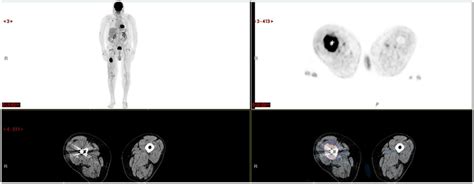 Voluminous Hypermetabolic Lytic Lesion Of The Right Femoral Shaft Download Scientific Diagram