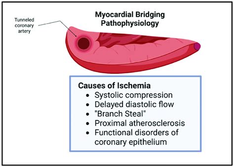 Myocardial Bridging Physiology Ischemia In Myocardial Bridging Is