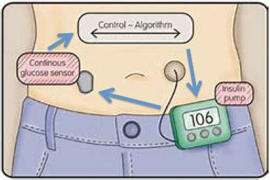 Optimizing Your Hybrid Closed Loop System