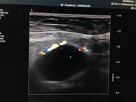 Vietnamese Medic Ultrasound Case 452 Mesenteric Castleman Disease Dr