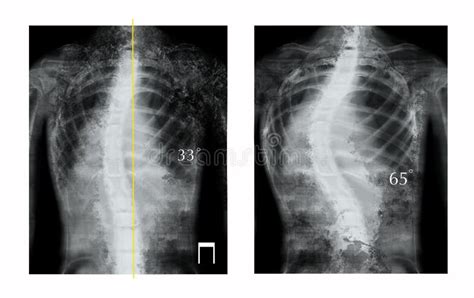 X Rays Of Human Spine Showing Curvature Patients Suffering From Scoliosis Stock Image Image