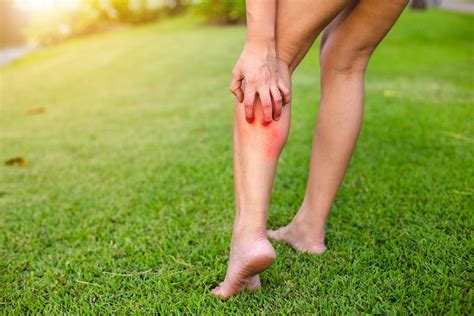 Top 12 Bị Côn Trùng đốt Sưng đỏ Bôi Thuốc Gì Mới Nhất Năm 2022 Máy Ép