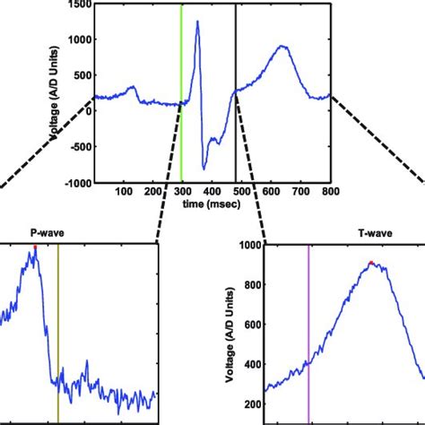 P And T Wave Feature Extraction Download Scientific Diagram
