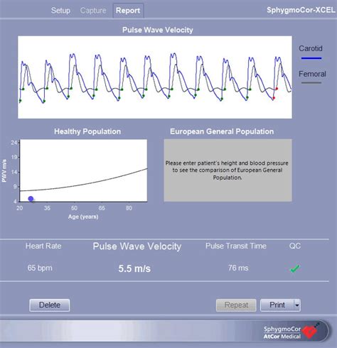 Pulse Wave Analysis And Velocity Human Neural Cardiovascular Control