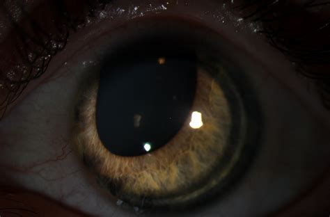 Atlas Entry Essential Iris Atrophy Iridocorneal Endothelial Ice Syndrome