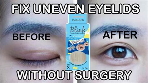How To Fix Uneven Eyelids
