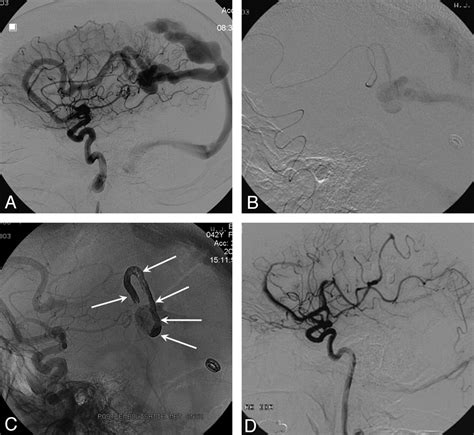 Onyx Coil Embolization Mri Safety At Lilian Knopwood Blog