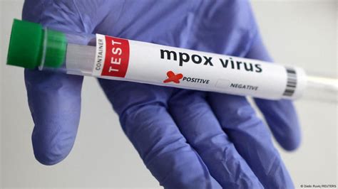 Mpox German School Temporarily Closed After Case Reported Dw 1216