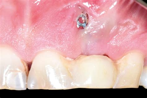 Management Of A Late Ti Mesh Exposure In The Aesthetic Area Using Jason
