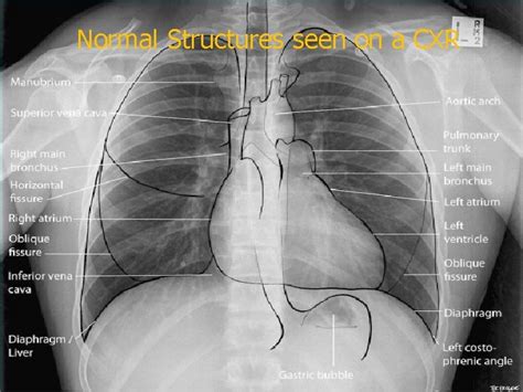 Part 2 0 Standardised Interpretation Of Paediatric Cxr