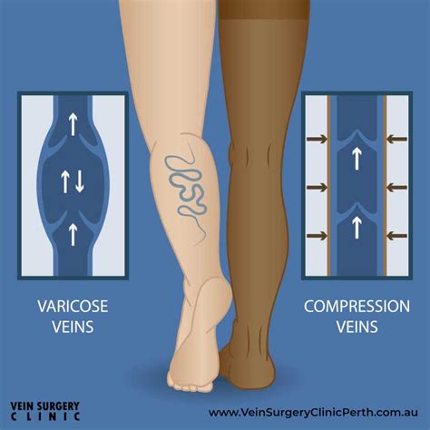 Compression Therapy Vein Surgery Clinic Of Perth Subiaco