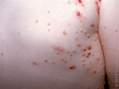 Molluscum Contagiosum Causes Symptoms And Treatment