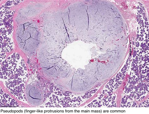 Pathology Outlines Pleomorphic Adenoma