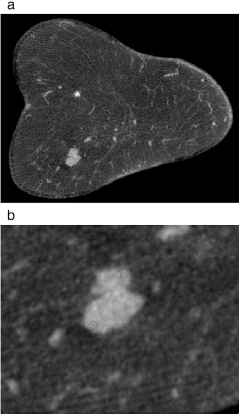 Imaging Findings In A 82 Year Old Woman With Mucinous Carcinoma A