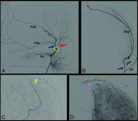 Middle Meningeal Artery