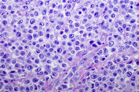 Trial Testing Lonca R In Relapsed Refractory Diffuse Large B Cell Lymphoma Cancer Therapy Advisor