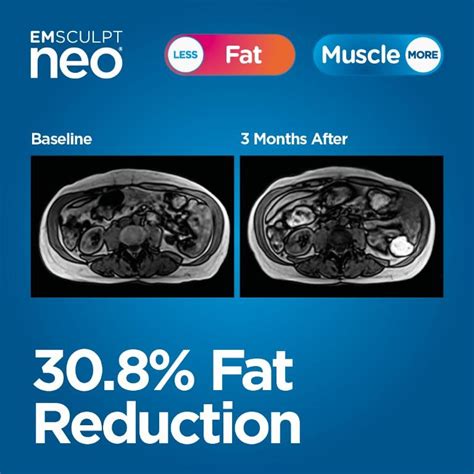 Nov Promo Authentic EmSculpt Neo FDA HSA Approved Diastasis Recti Muscle Separation Mummy