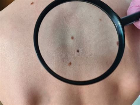 Dermatologist With Magnifying Glass Examines Patient In Clinic Stock