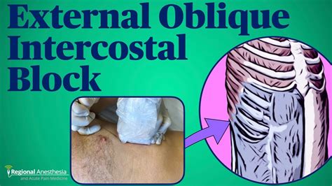 External Oblique Intercostal Fascial Plane Block Youtube