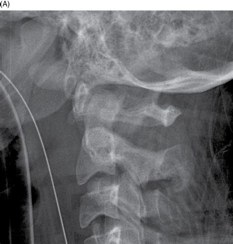 Non Displaced Cervical Fracture