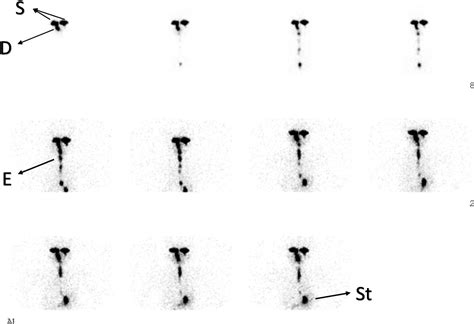 Gastric Visualization In Dacryoscintigraphy An Unequivocal Clinical Nuclear Medicine