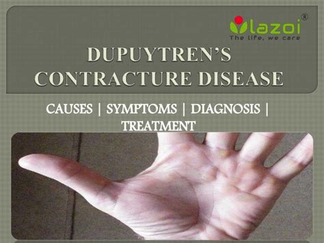 Dupuytrens Contracture Disease Causes Symptoms And Treatment