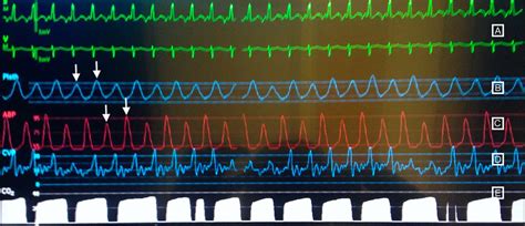 Pulsus Alternans A Visual Clue To A Grave Disorder Bmj Case Reports