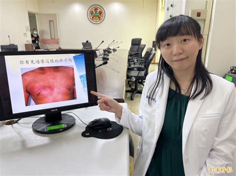 皮蛇繞一圈會死？ 醫：從兩側長表示病患身體狀況很差 自由健康網