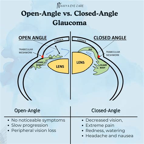 Closed Angle Glaucoma Vision