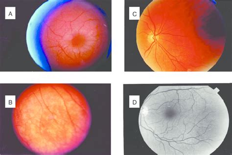 A Central Retinopathy Demonstrating Perimacular Dots And Flecks B