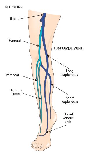 Greater Saphenous Vein Thrombosis Treatment