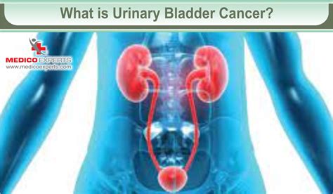 Answered Is Urinary Bladder Cancer Curable
