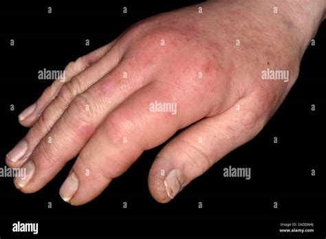 Cellulitis Hand Cellulitis Treatment And When To Worry