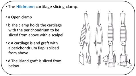 Technique Of Harvesting Cartilage Graft For Cartilage Tympanoplasty Dr