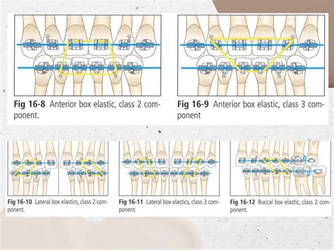 Intraoral Elastics In Orthodontics Pptx