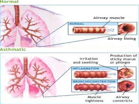 Status Asthmaticus Ppt