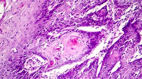 Carcinoma De Células Escamosas Cómo Identificar Esta Forma De Cáncer Y