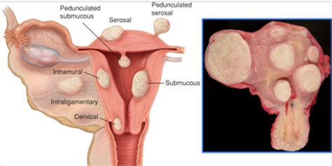 Obgyn Uterine Disorders Flashcards Quizlet