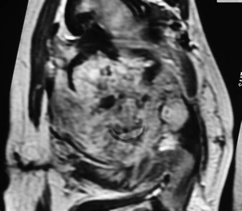 Abdomen Pelvic Teratoma Radiopaedia