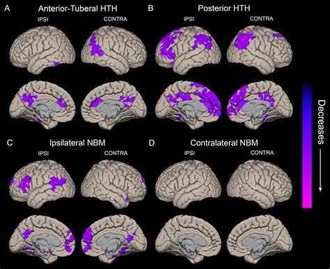 Abnormal Functional Connectivity Of The Posterior Hypothalamus And Other Arousal Regions In