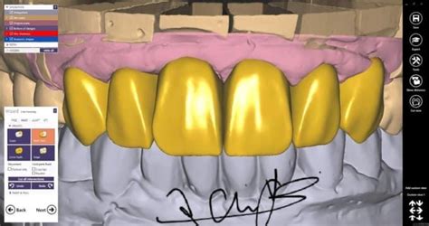Exocad I Will Design Hight Quality All Types Of Dentures For You Using