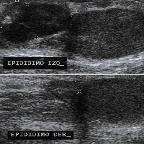 Fundoscopy Temporal And Inferior Nasal Periphlebitis Download Scientific Diagram